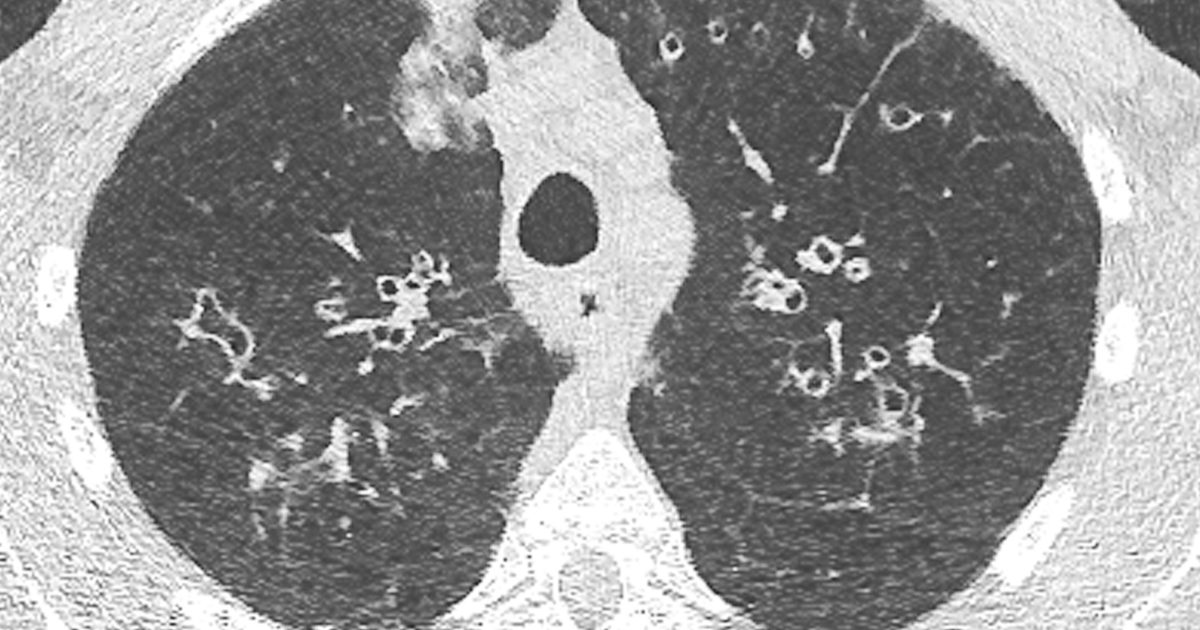 Ultra-low dose CT chest | Radiology SA Ultra-low dose CT chest | Radiology SA